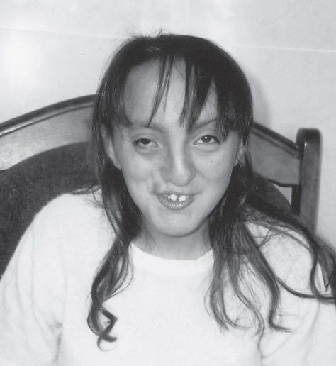 Elsa – Facial Malformations Cleft Lip and Palate | Villa La Paz Foundation