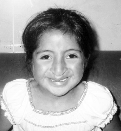 Flor – Post-op Cleft Lip and Palate Surgery | Villa La Paz Foundation