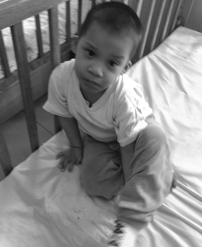 Yomar – Clubbed Feet | Villa La Paz Foundation